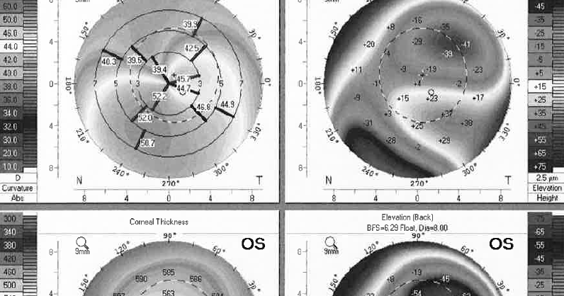A Two-Decade Journey with Keratoconus | Keratoconus Group
