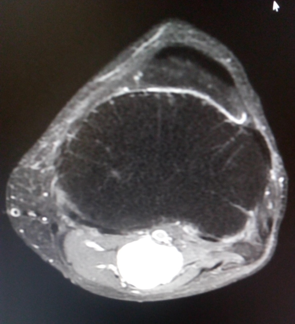 Neurogenic tumor: Teaching Points - Sumer's Radiology Blog