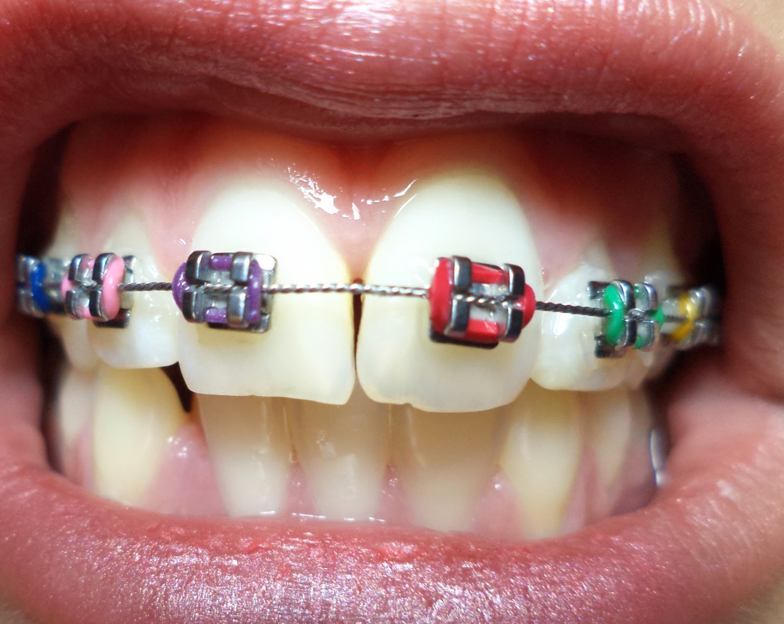 Mis Brackets: Paso a Paso [Mi experiencia]: 7-08-2014 - Cambio de Ligas