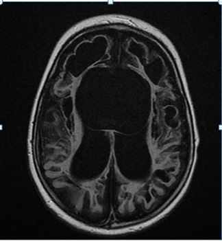 pediatric neurology: The consequence of a reversal sign