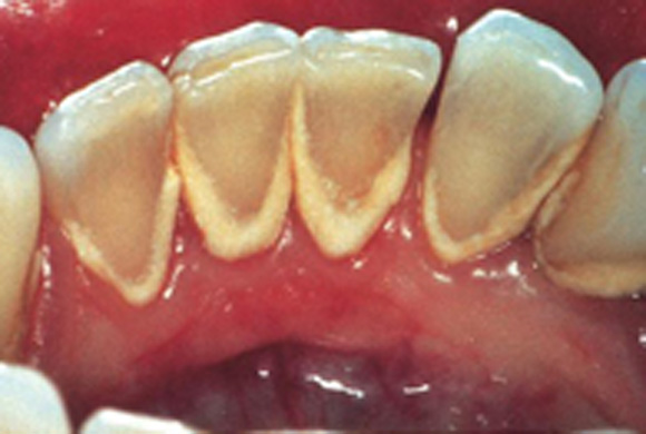 How Dental Caries Happen and the Treatments