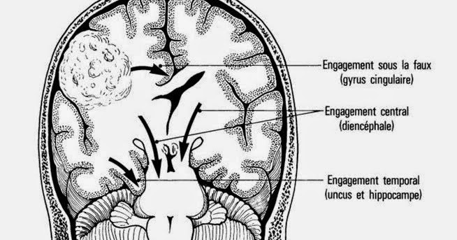 L'hypertension intracrânienne (HTIC) | Récap' IDE