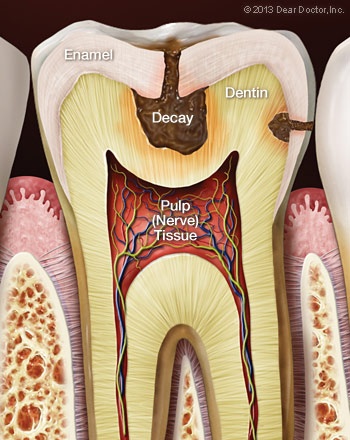 Entendiendo mi sonrisa : Pulpitis Reversible e Irreversible