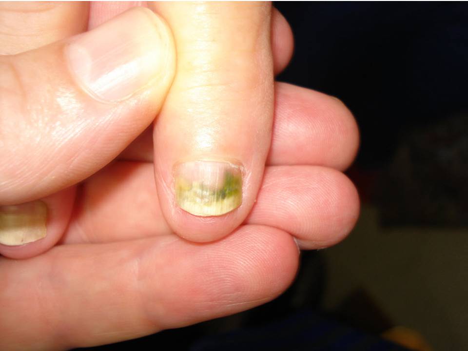 Consultations in Dermatology: The Crumbly Nail - Onychomycosis