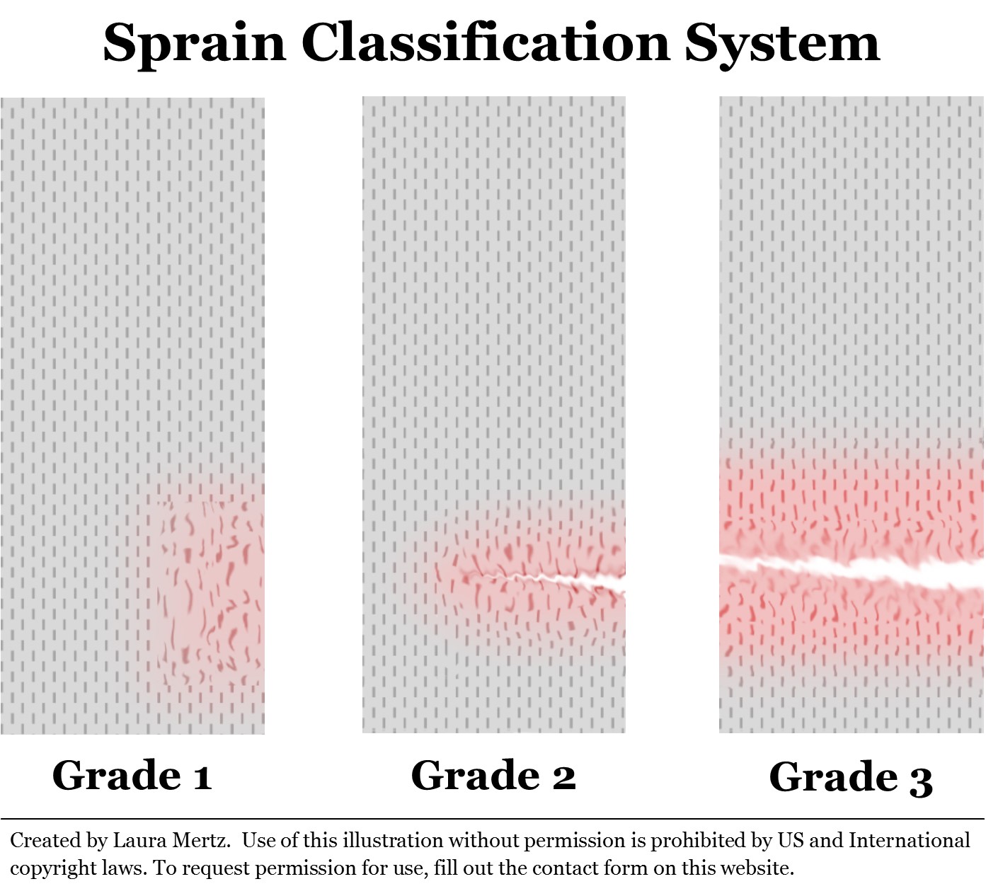 Performing Arts Medicine: Is it a Sprain or a Strain? (part 1)