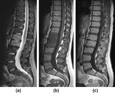 Skull and Spine: Modic Type 1 change and low back pain