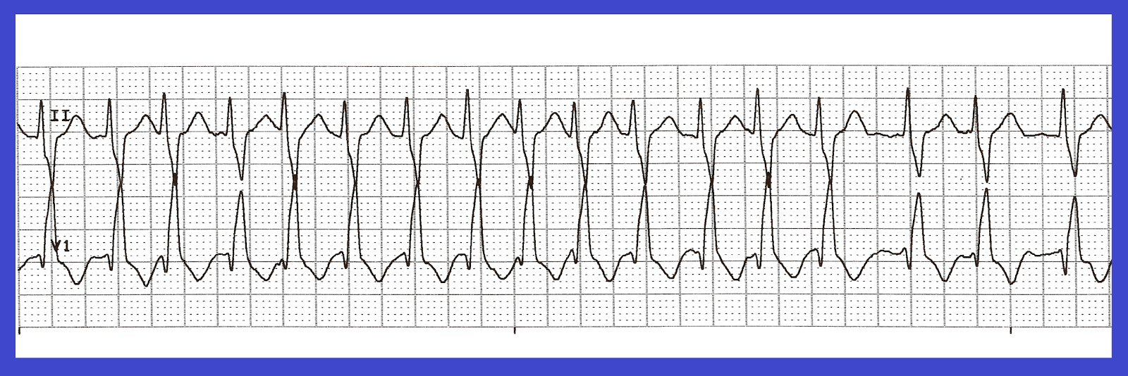Various Atrial Fibrillations