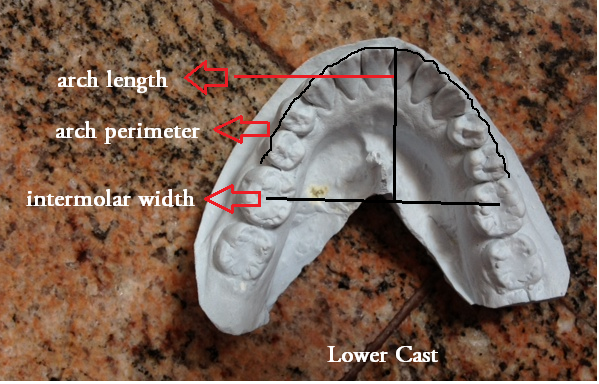 My Journey to LIFE. (previously My Invisalign Diaries): June 2013