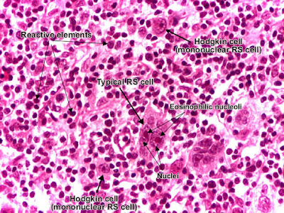 موقع الدكتور أحمد كلحى: باثولوجى Pathology Slides : Hematopathology