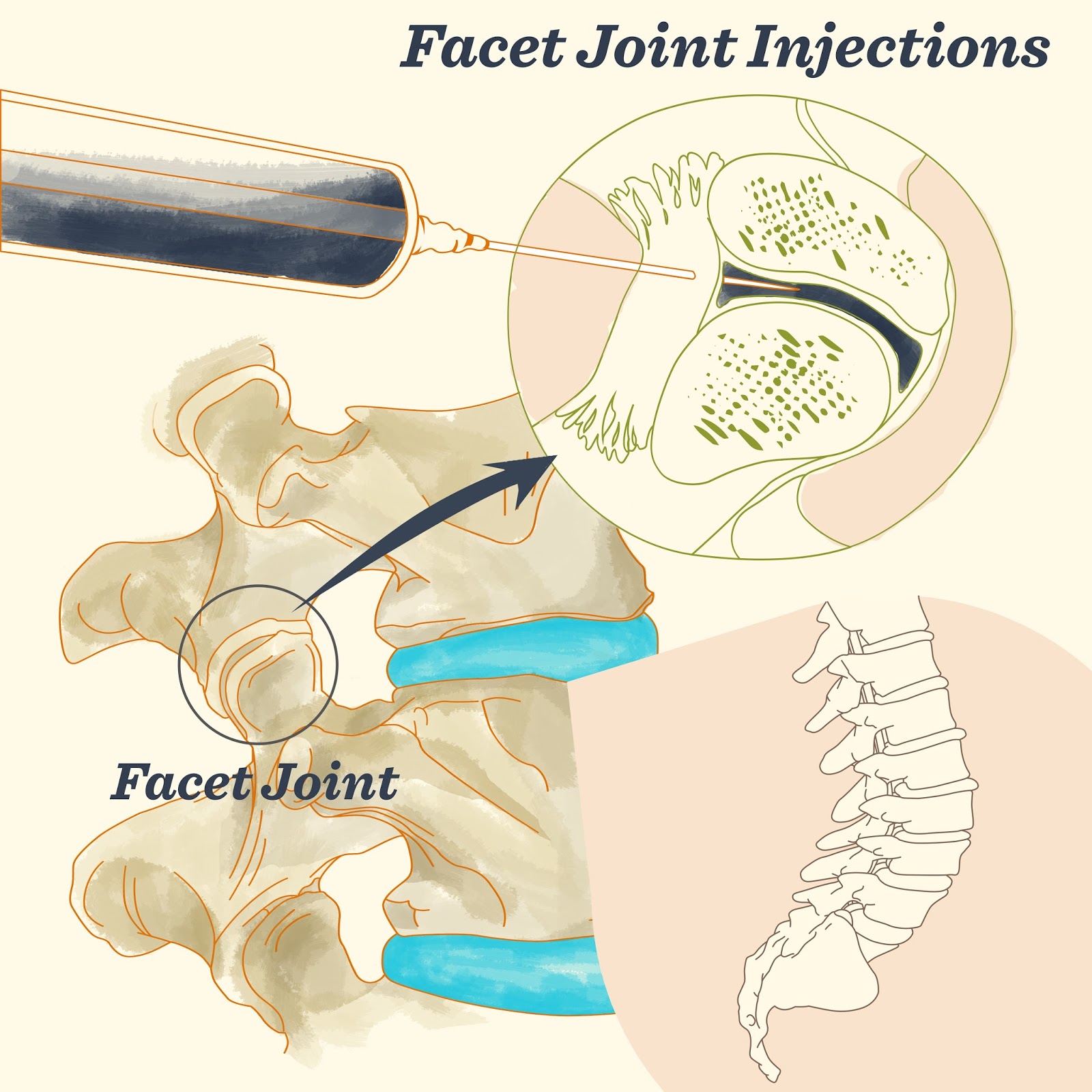 Facet Joint Injection guideline ~ akufisio.blogspot