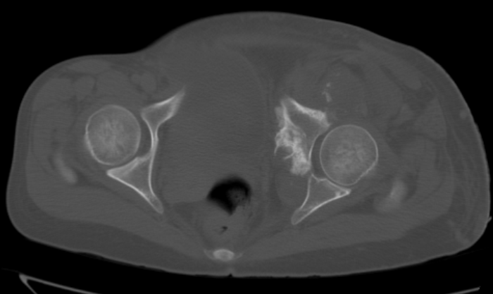 Pelvic Osteosarcoma-CT - Sumer's Radiology Blog