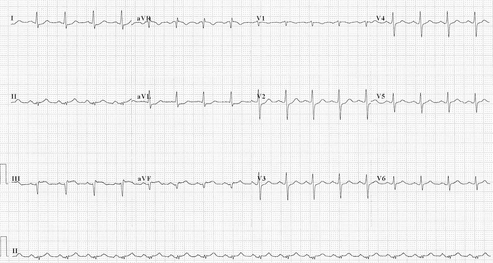 ECG of the Week: ECG of the Week - 18th September 2017 - Interpretation