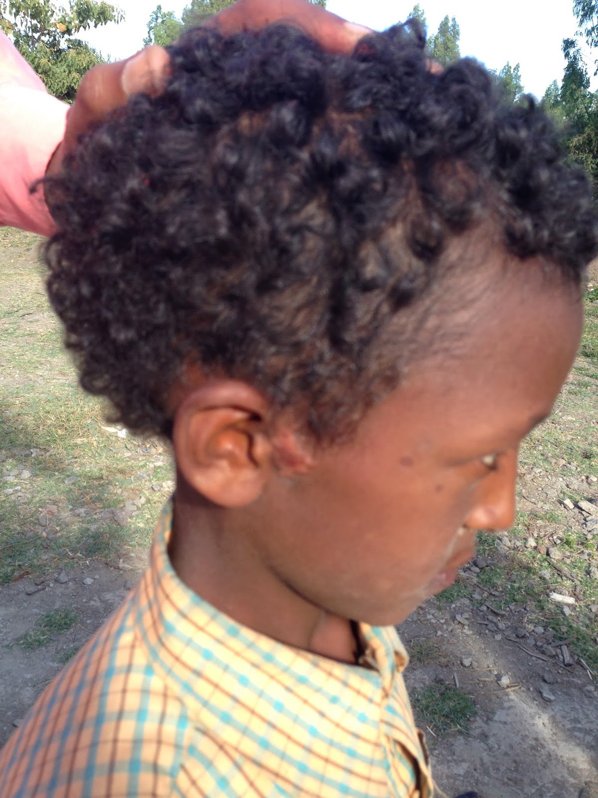 Engage Now Africa: Ethiopia: Keloid Removal Surgery Success Story