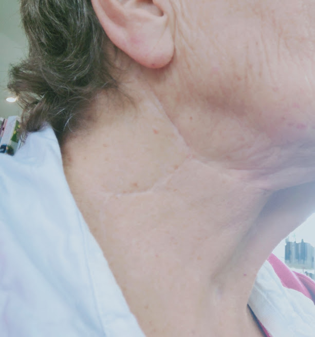 Dissecting the neck dissection - Head & Neck Cancer Support Aotearoa