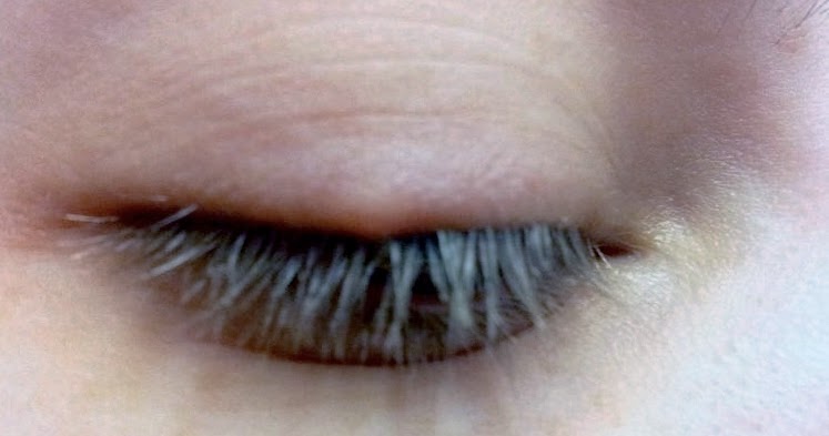 Red Bump On Lash Line Ingrown Eyelash Pictures Treatments And Prevention red-bump-on-lash-line-ingrown-eyelash-pictures-treatments-and-prevention
