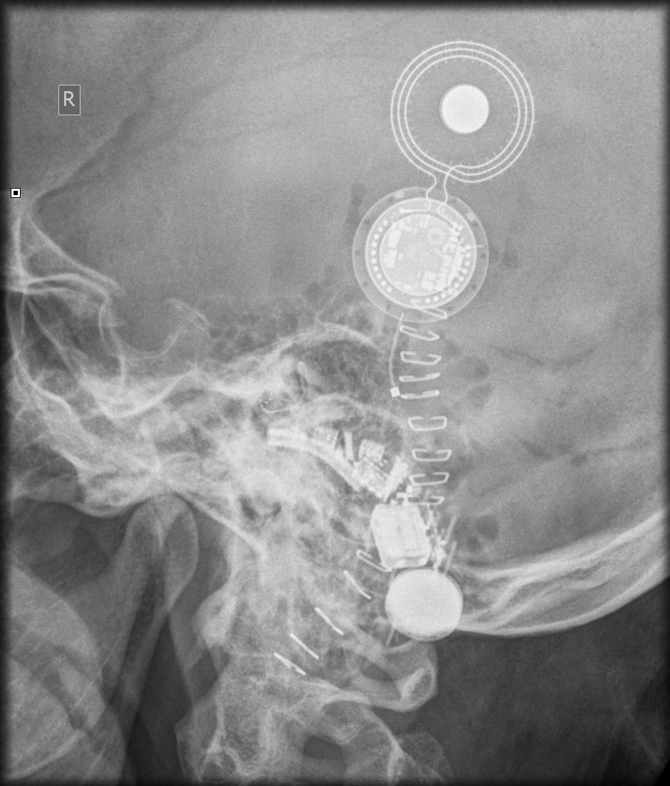 Jill's Cochlear Implant Journey: Pretty amazing...