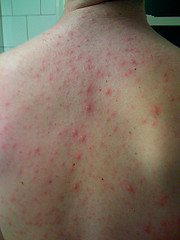 The Body In Form: Healing Chicken Pox Naturally