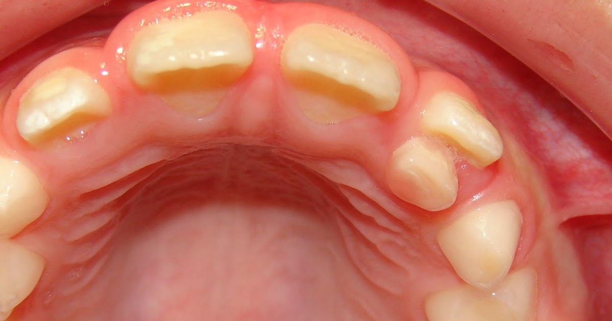 Zona Ortodoncia: Erupción de dientes permanentes