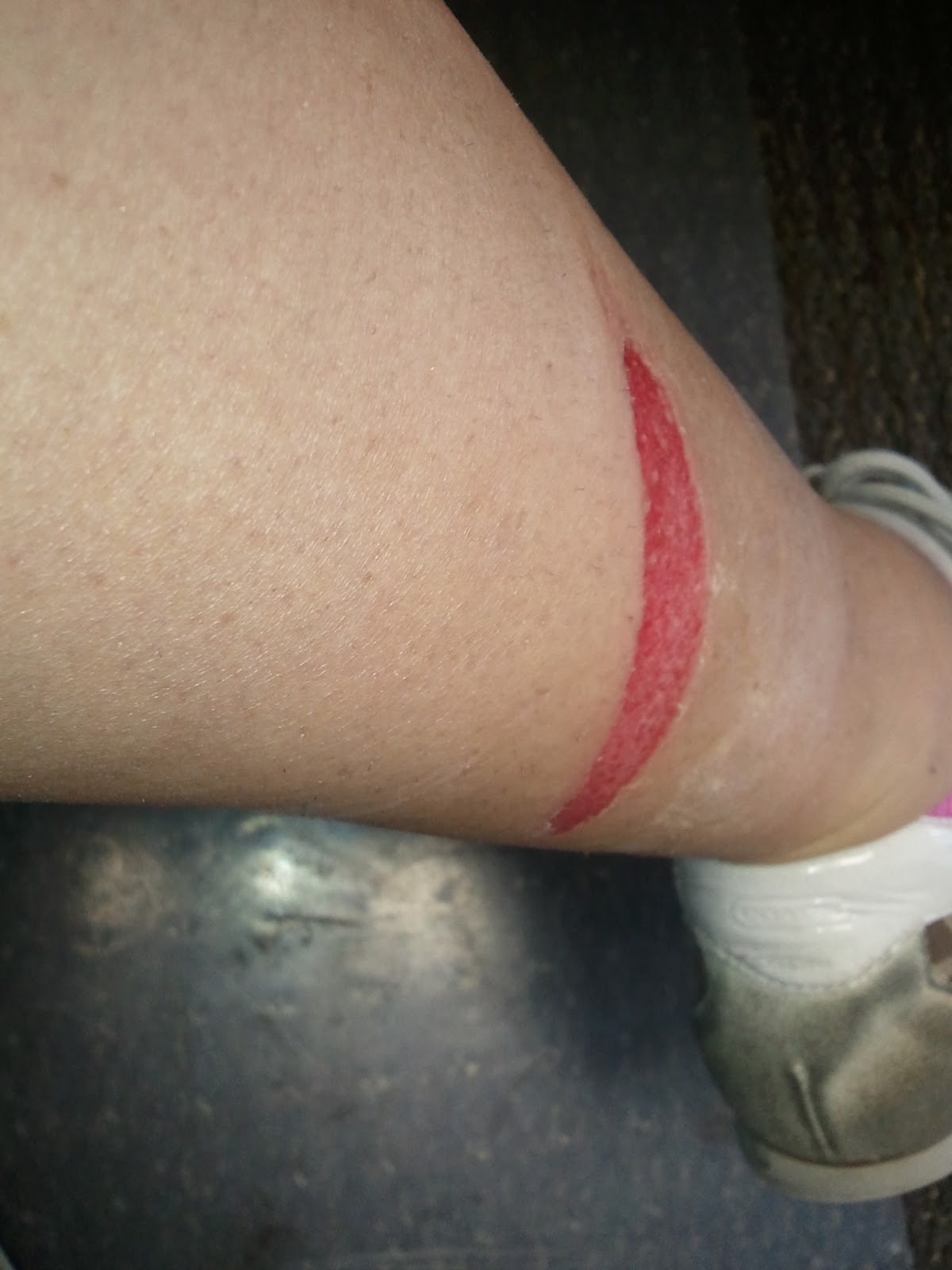 Rope Burn Turning Yellow at Lilian Dixson blog