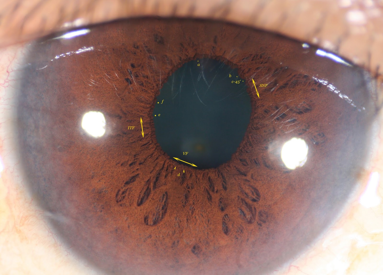 Modern & Multidimensional Iridology: Crypts & Lacunae at Pupillary Zone ...