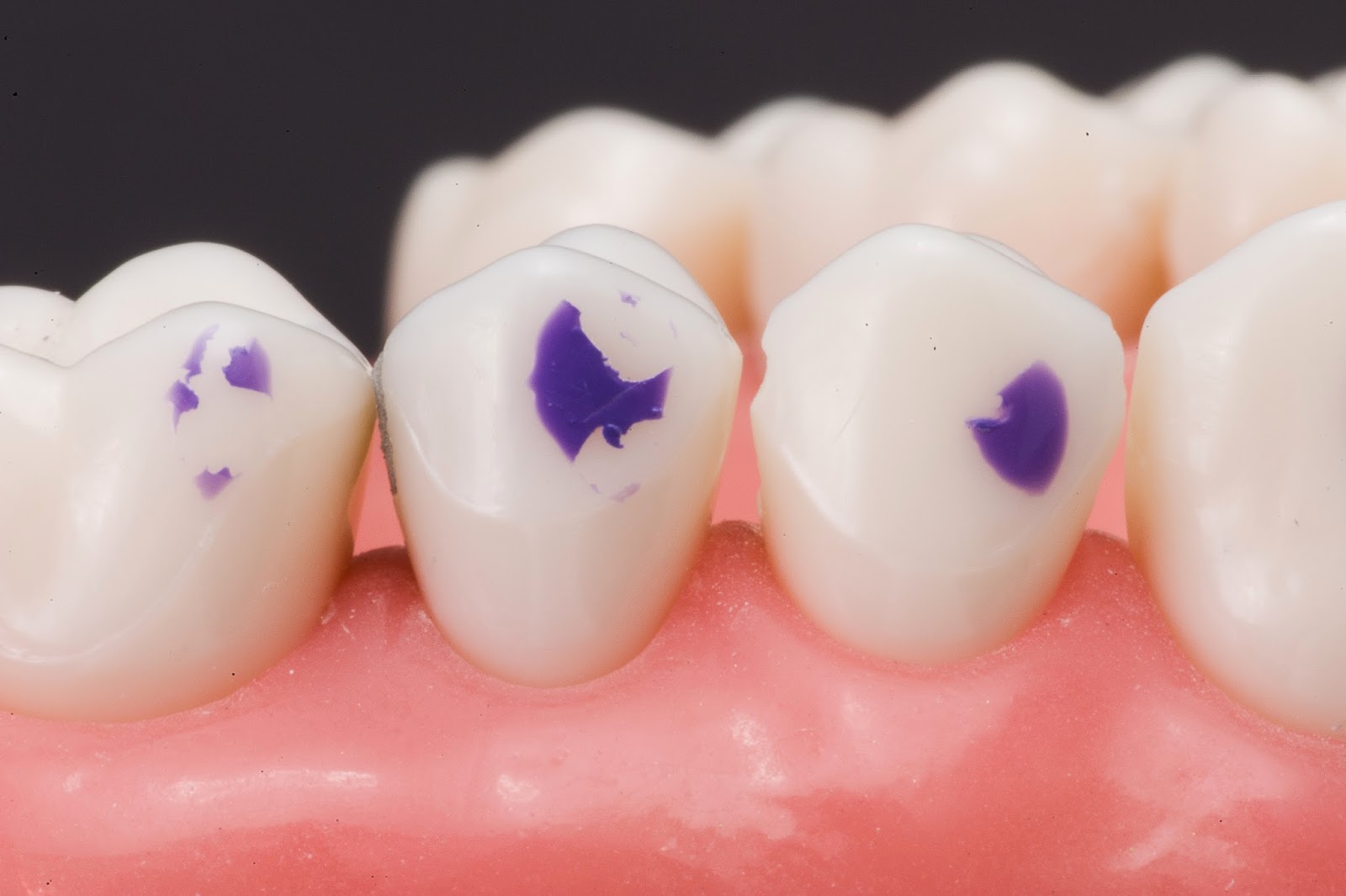 Operative Practical: 12 MOD Prep and 13 DO Amalgam Fill
