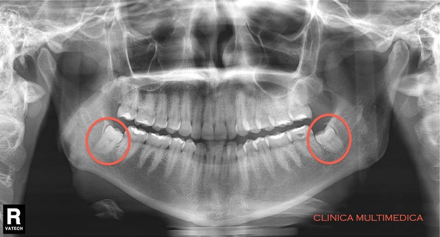 Odontología - Elsa & Asociados: Tercer molar o molar del juicio.