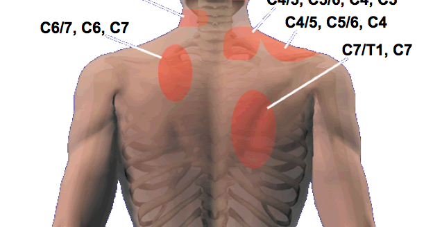 Cloward sign & Cervical Referral Patterns | Modern Manual Therapy Blog