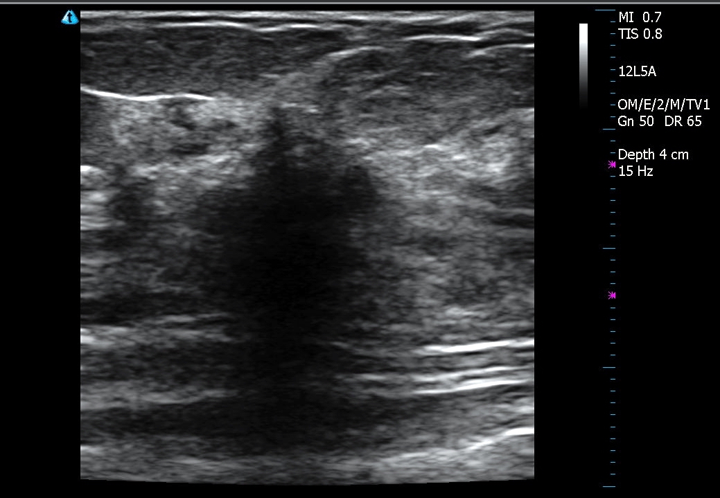 Vietnamese Medic Ultrasound Case 337 Bilateral Breast Tumor Dr Phan