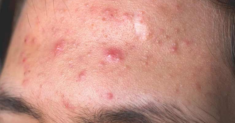 Como Hacer Desaparecer Los Granos Naturalmente - Tratamiento Para El ...