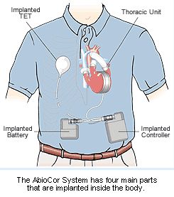 Nursing Informatics: Abiocor หัวใจเทียมอัจฉริยะ