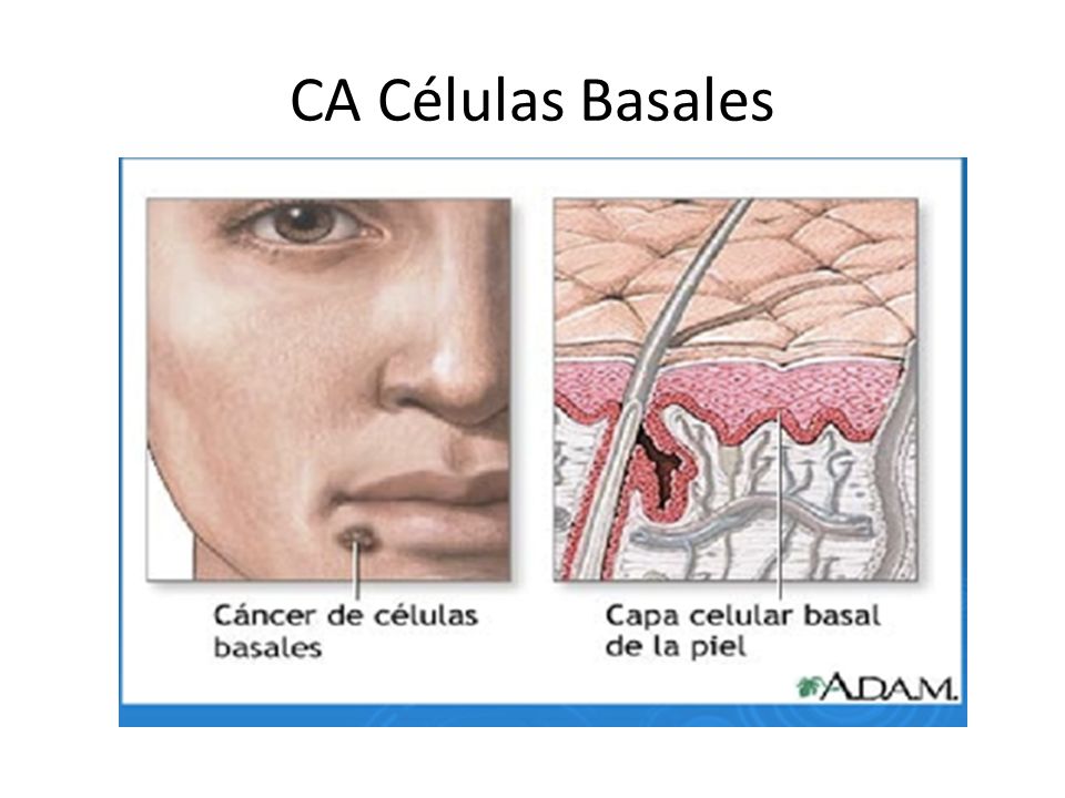 HeberFeron, fármaco para el tratamiento del cáncer de piel, disponible ...