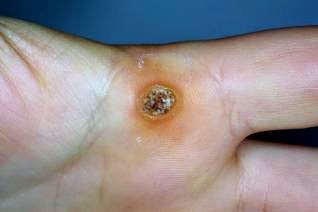 Photos of Warts on Hands and Fingers ~ How To Remove Moles, Warts, Skin ...