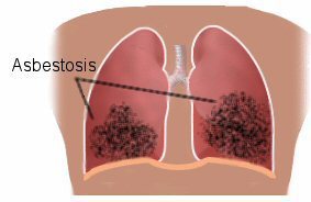 Asbestosis : Lung Disease Due to Asbestos - ASBESTOSIS