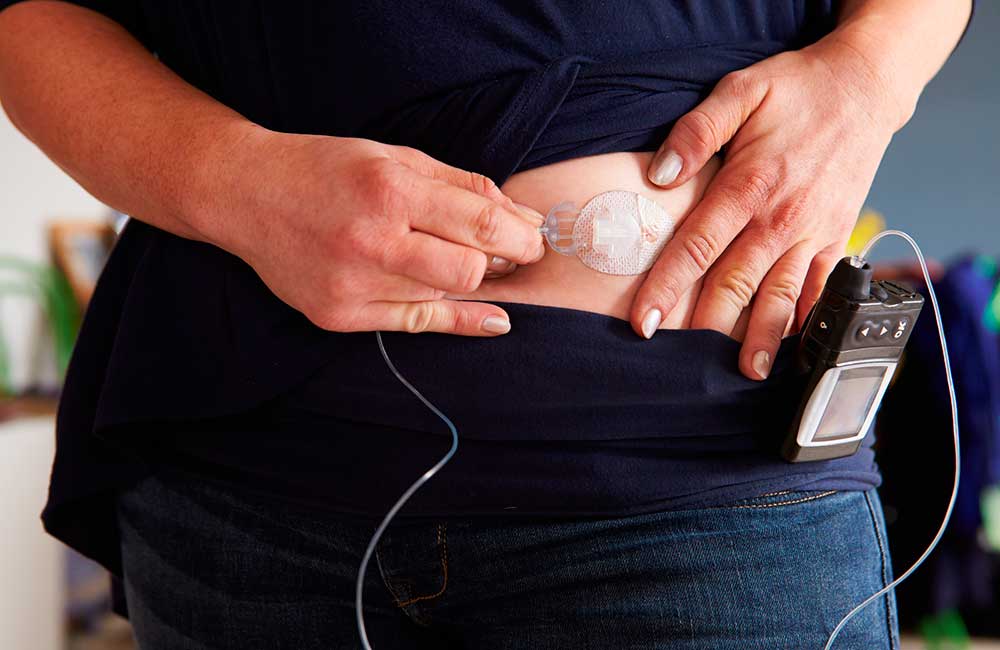 DIABETE TIPO 1: UMA BOMBA DE INSULINA SERIA MELHOR PARA O SEU DIABETES?