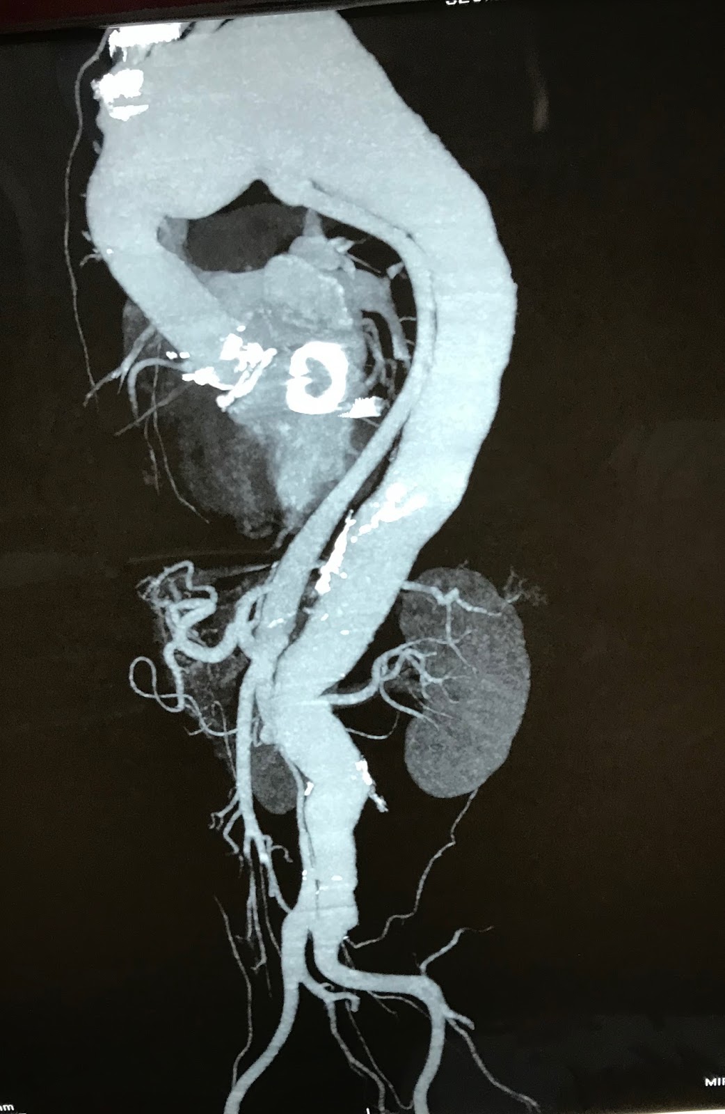 VIETNAMESE MEDIC ULTRASOUND: CASE 490: ANECHOIC CRESCENT' S SIGN OF ...