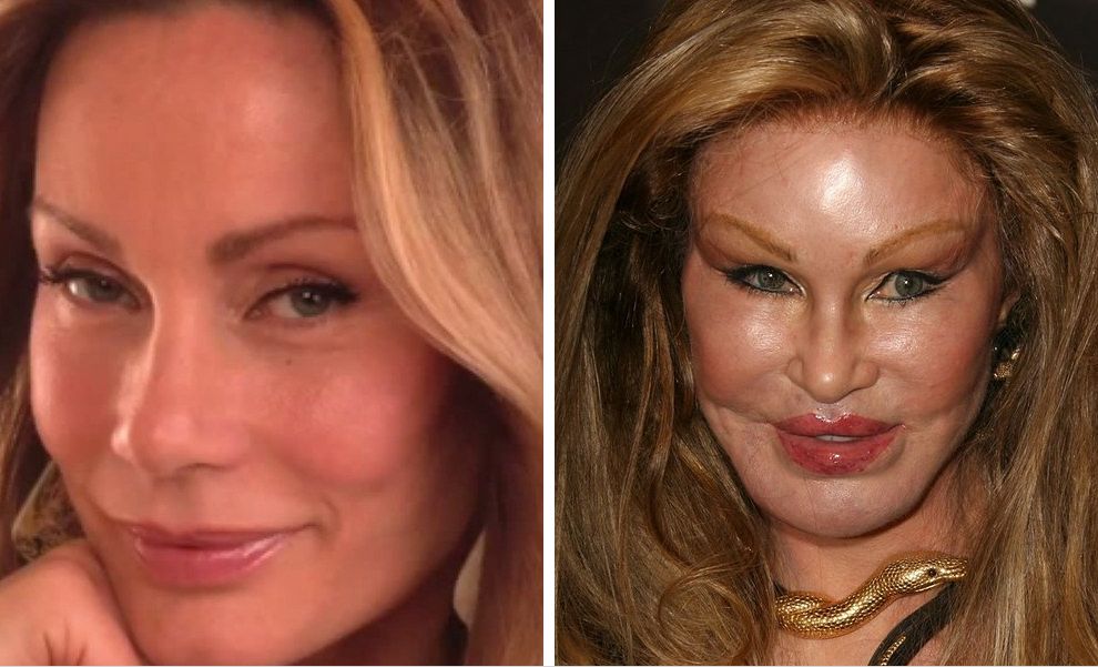 Jocelyn Wildenstein and Donatello Versace Plastic Surgery Gone Wrong ...