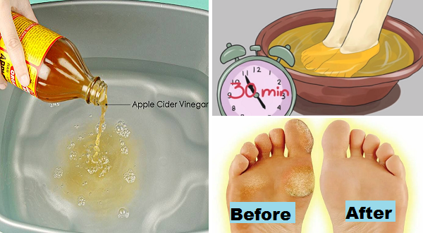 Ano Gamot Sa Mabahong Paa - paa mesa