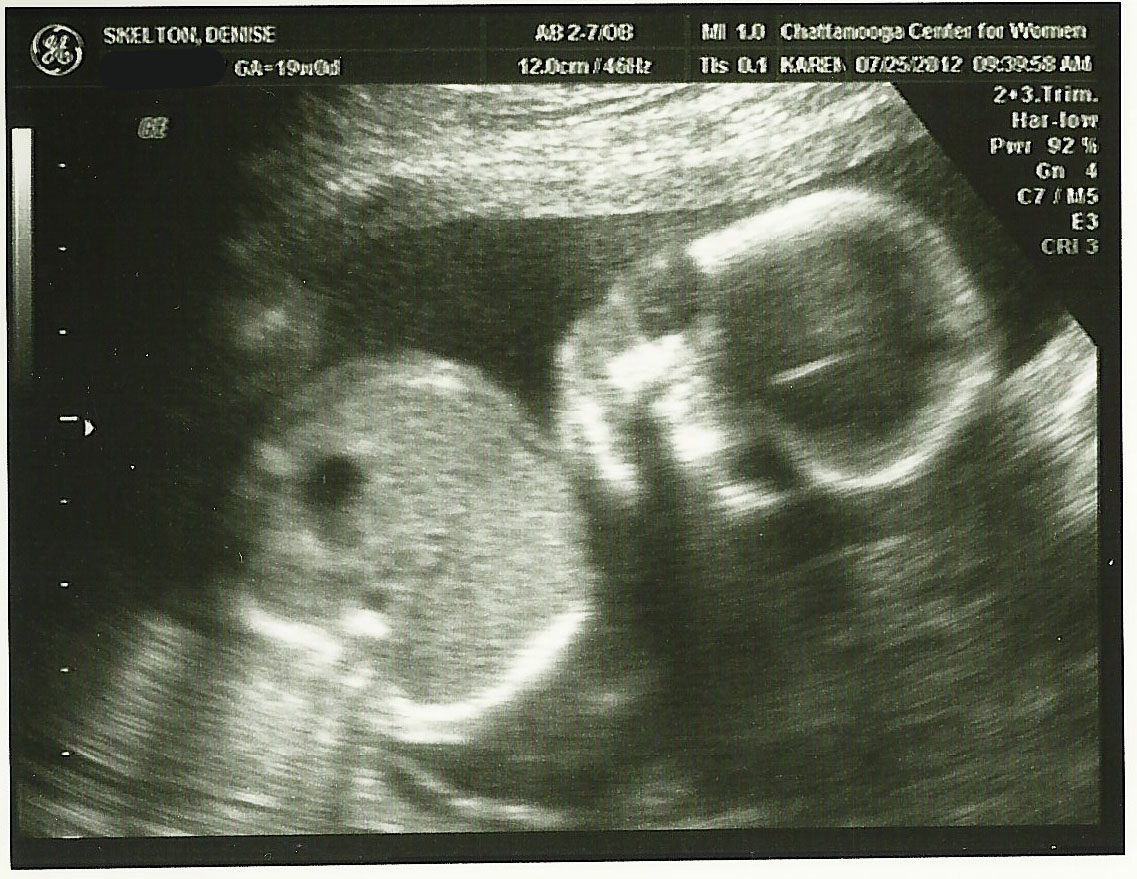 Arrows in Our Hand: 19 Week Ultrasound
