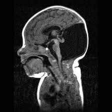 stimr.com: What is Dandy-Walker Syndrome?