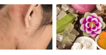Acne Cyst On Neck: What is It? What Causes it?