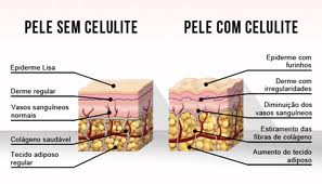 Beautiful Asywaq: Apa itu Selulit (cellulite)