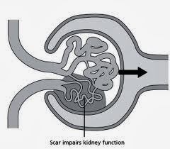Medical Treatment Pictures-for Better Understanding: Focal Segmental ...