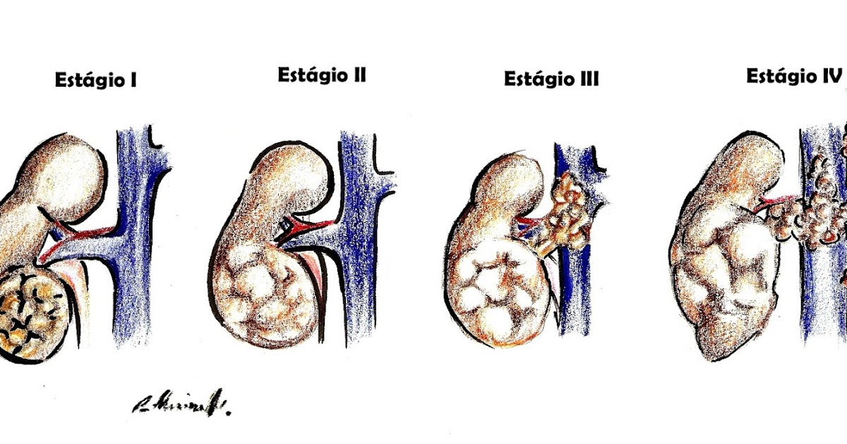 Flanco Esquerdo : Câncer de rim: um risco silencioso e fatal
