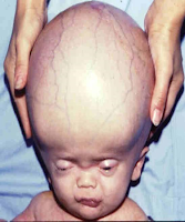 Salud Universidad Wiener: Hidrocefalia