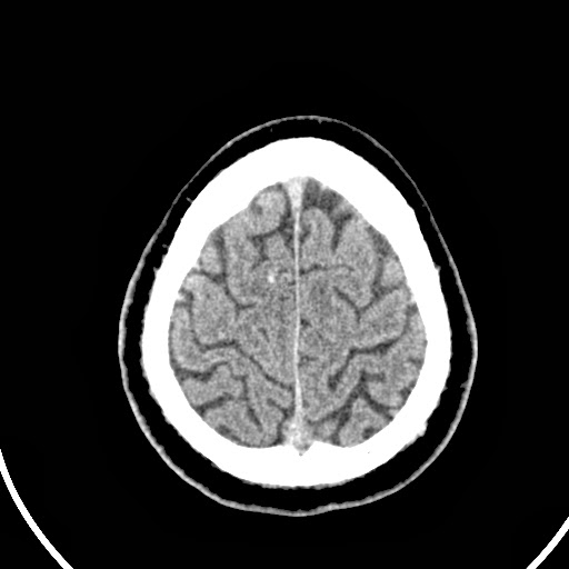 Ultimate Radiology : Multiple Cavernomas in Brain
