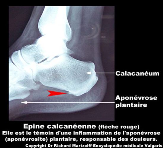 Epine calcanéenne | Jean J. Weaver