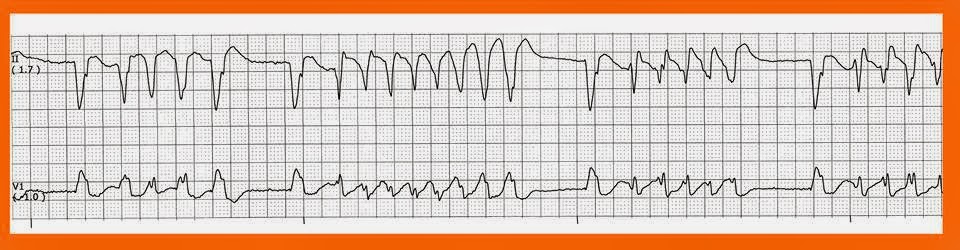 Various Ventricular Tachycardias