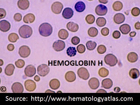 Lab Atlas: Hemoglobin H