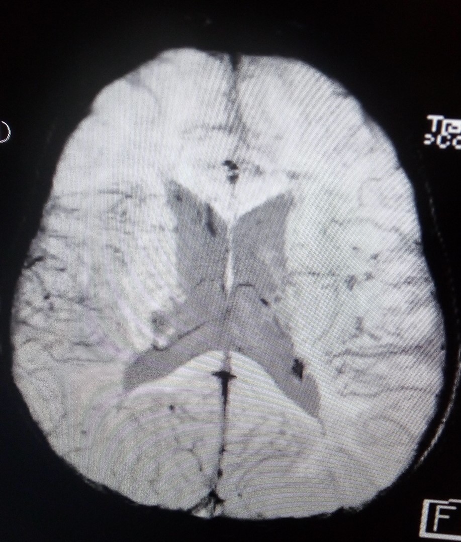 Tuberous Sclerosis : Case Report - Sumer's Radiology Blog