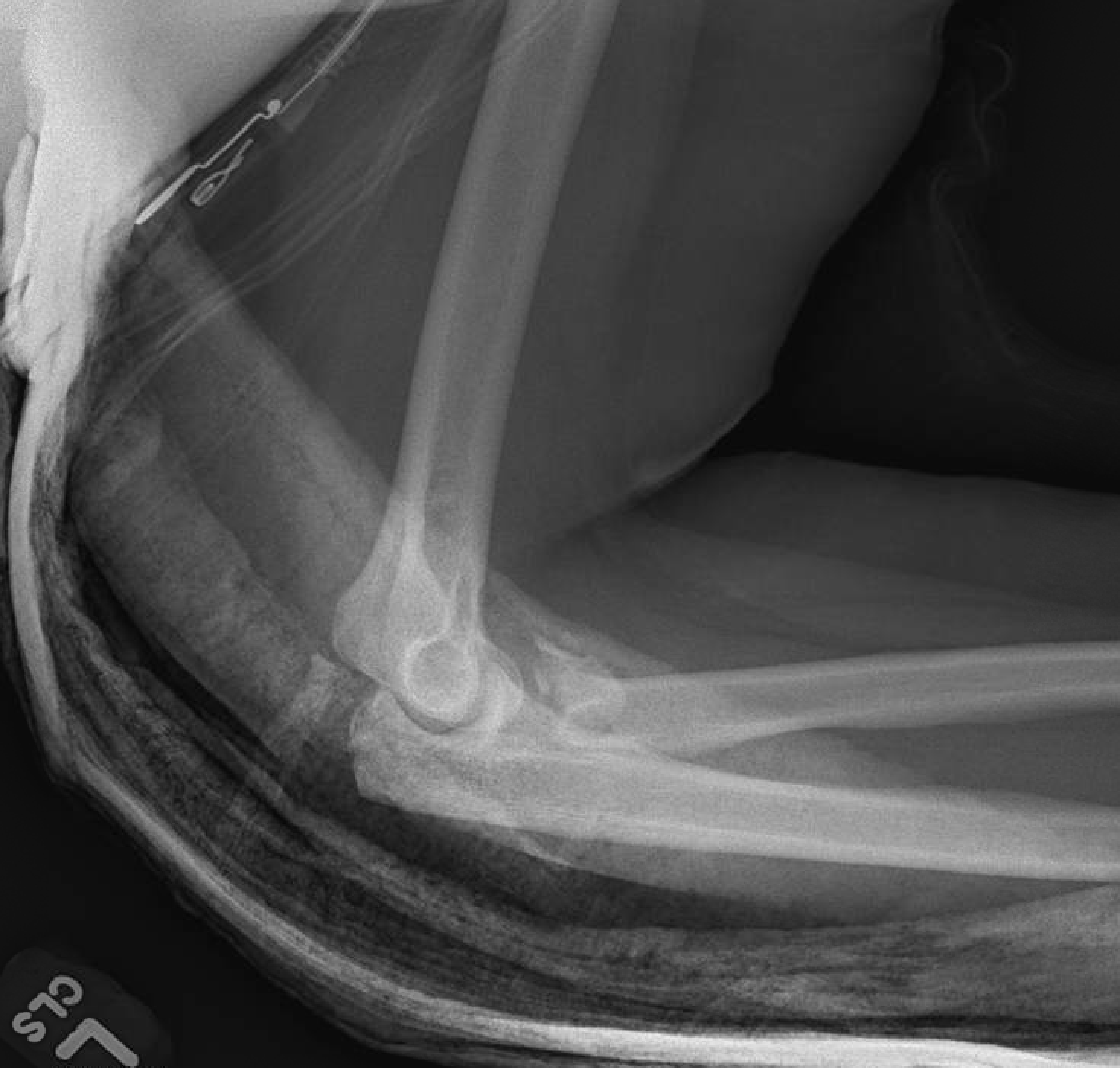 Shoulder and Elbow Surgery: Terrible triad injury. The importance of ...